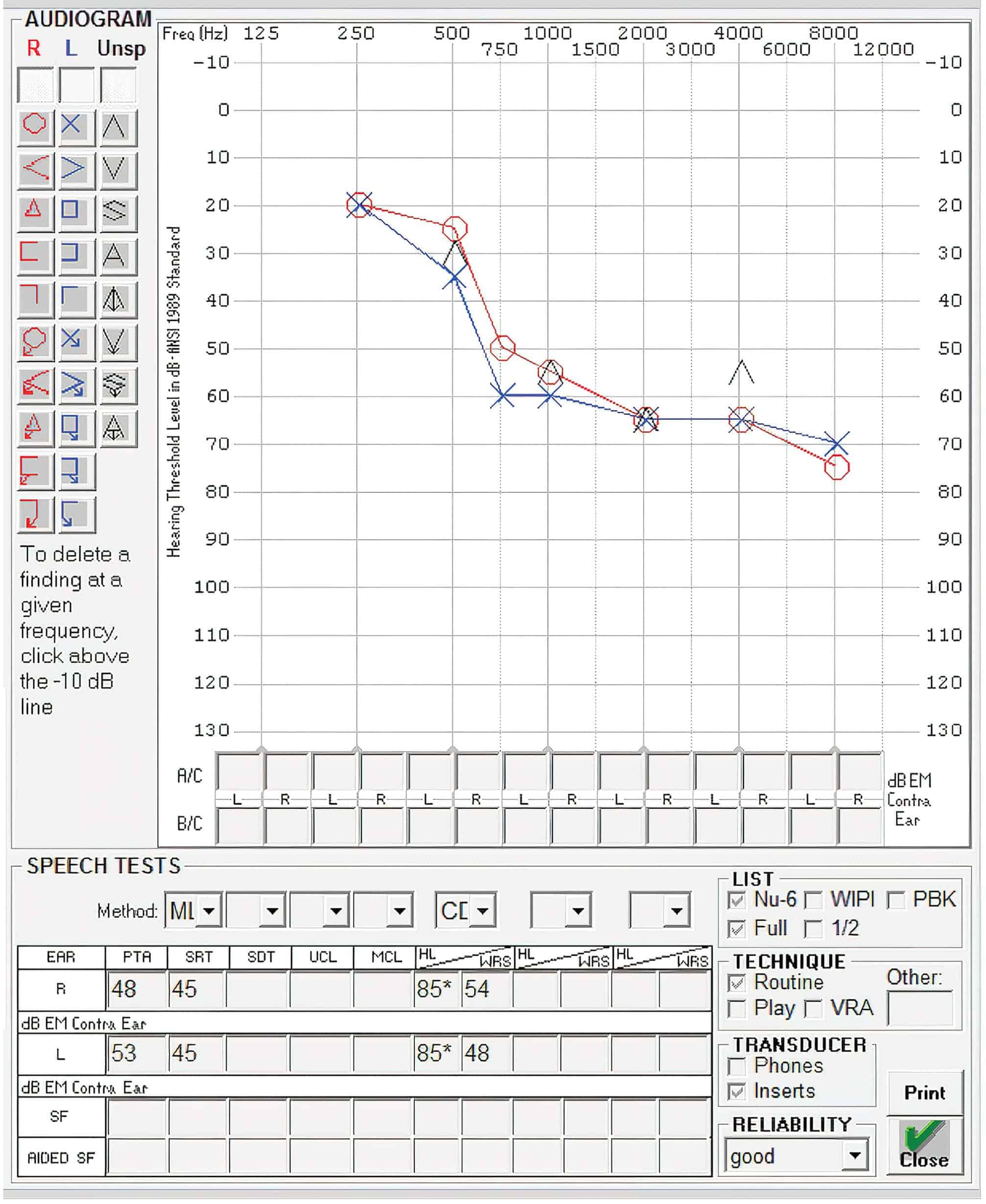 Cochlear Implantation: The Most Misunderstood and Under-Recommended ...